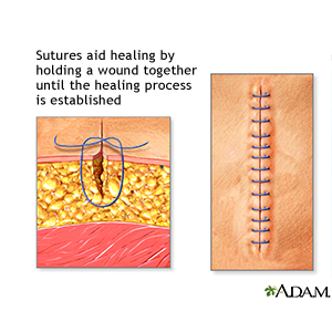 Suture Care (General Information)